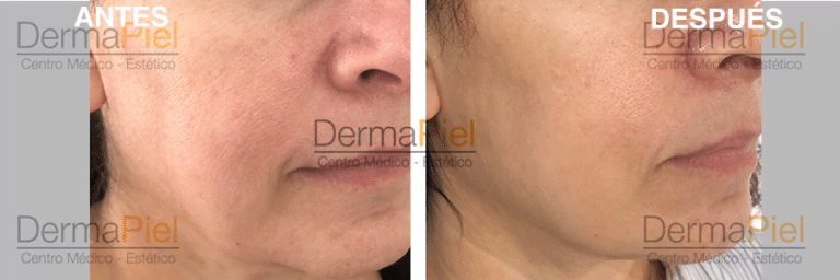 Quemadores de grasa facial