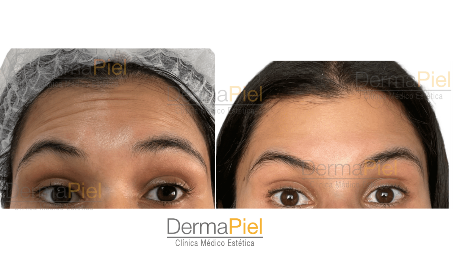 Botox - Tratamientos Antiarrugas con Botox Facial | Dermapiel