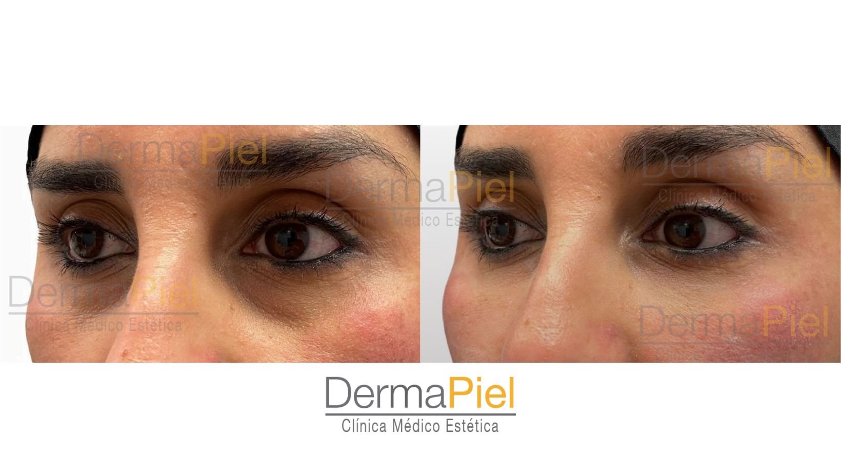 antes y despues relleno de ojeras con acido hialurónico dermapiel 3 ... antes y despues relleno de ojeras con acido hialurónico dermapiel 3 ...