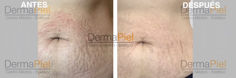 laser estrias 6 - Dermapiel