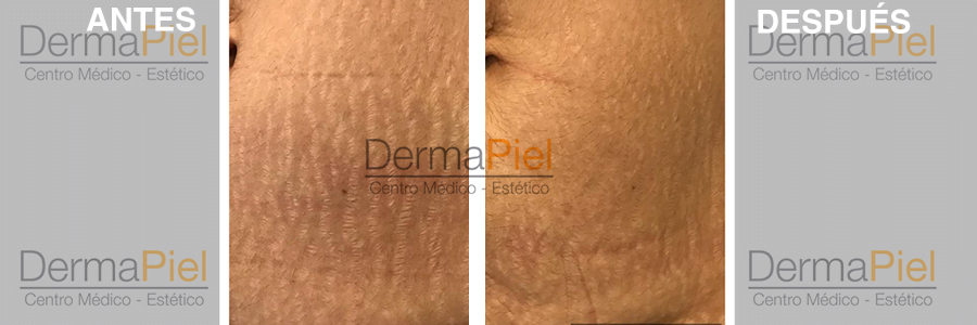 laser estrias antes y depues 7 - Dermapiel