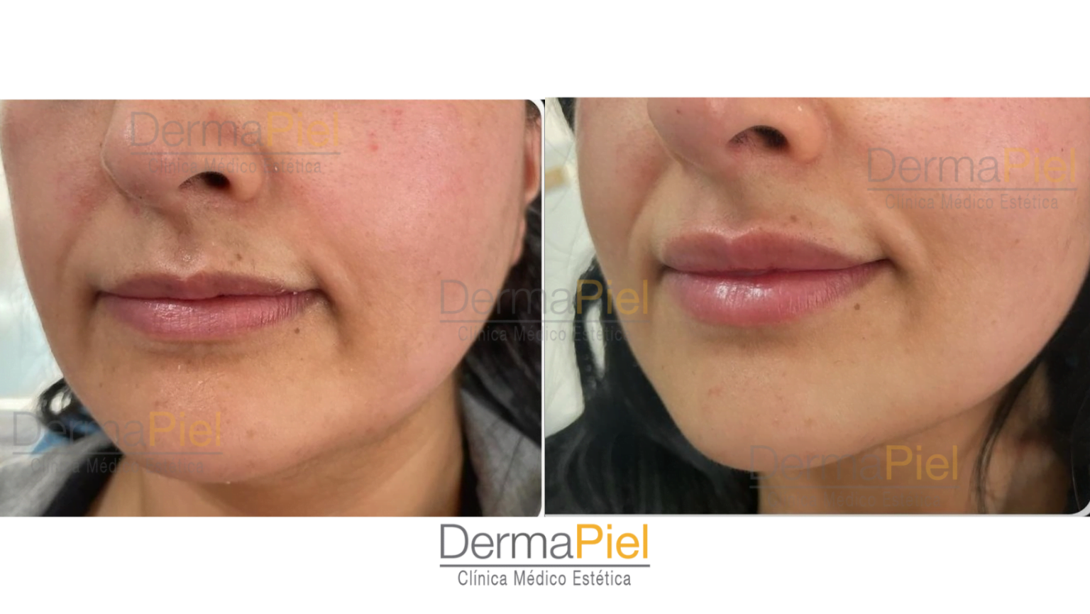 Relleno y aumento labial, relleno de labios - Dermapiel