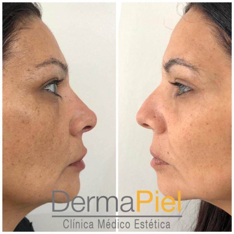 rinomodelacion mejora tu perfil en minutos - Dermapiel