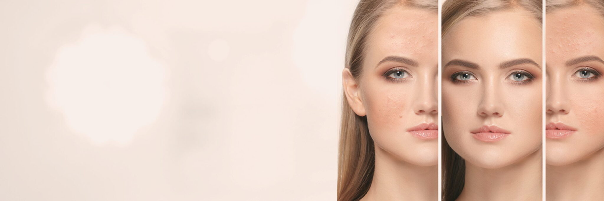 BANNER_ACNE - Dermapiel