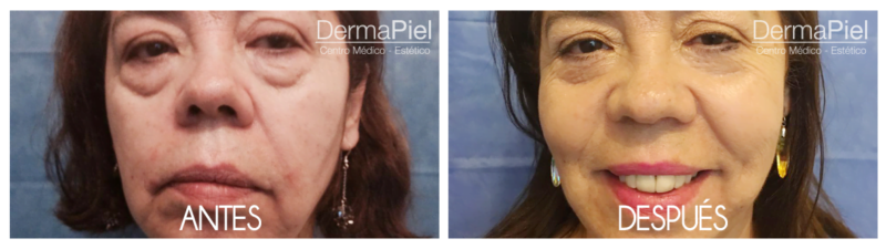 Cirugía de Párpados - Blefaroplastia | Dermapiel