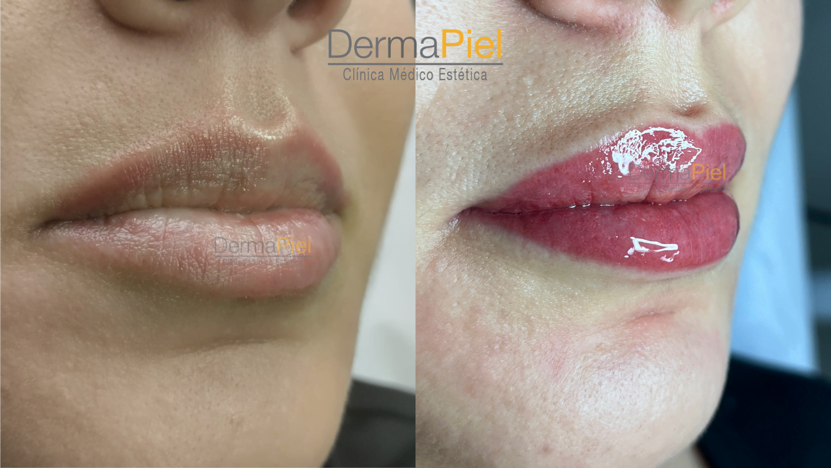Micropigmentación de Labios - Dermapiel