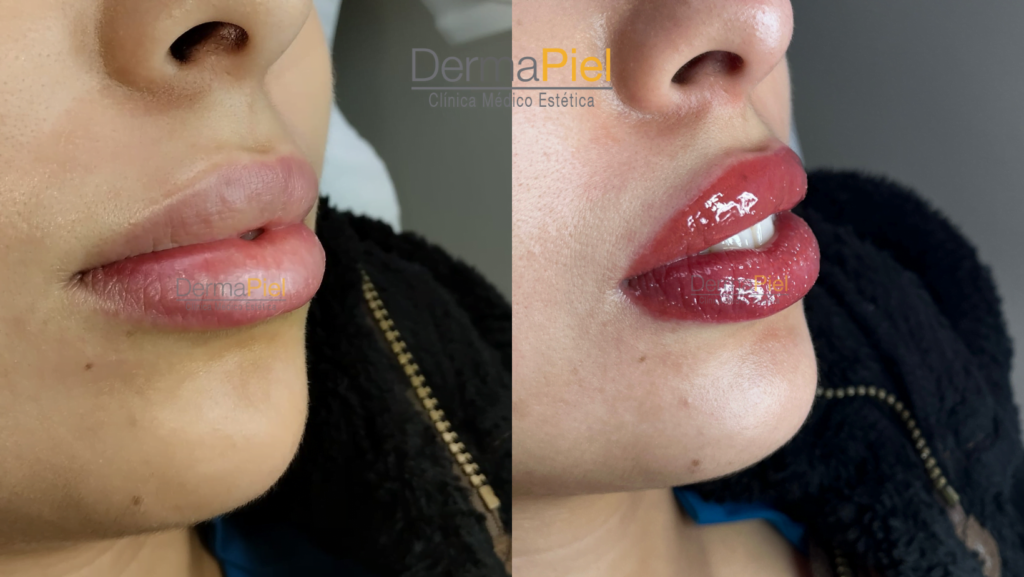 Micropigmentación de Labios - Dermapiel