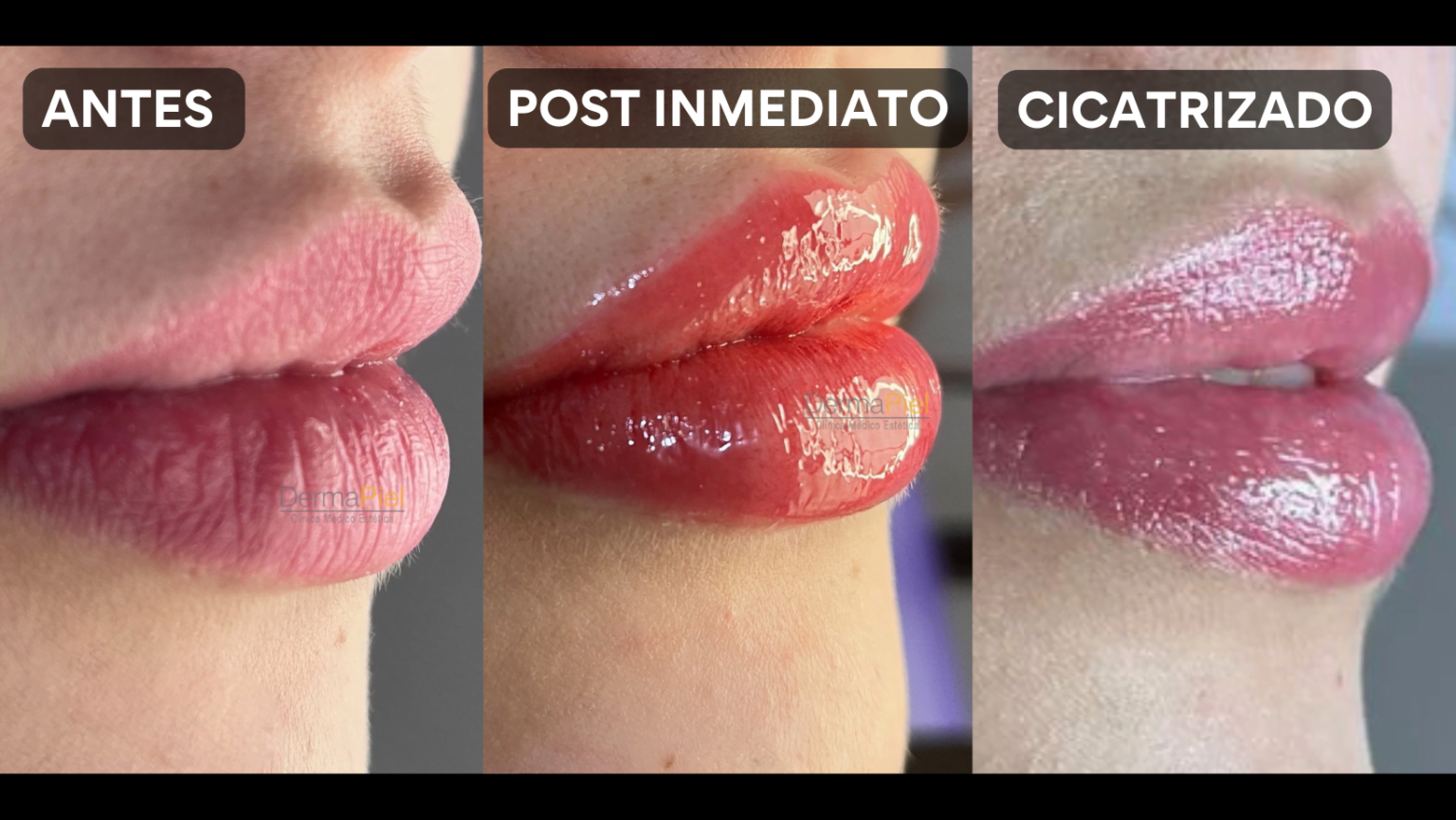 Micropigmentación de Labios - Dermapiel
