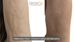 Tratamiento Fibrosis Post Operatoria - Dermapiel