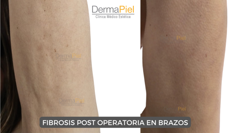Tratamiento Fibrosis Post Operatoria - Dermapiel