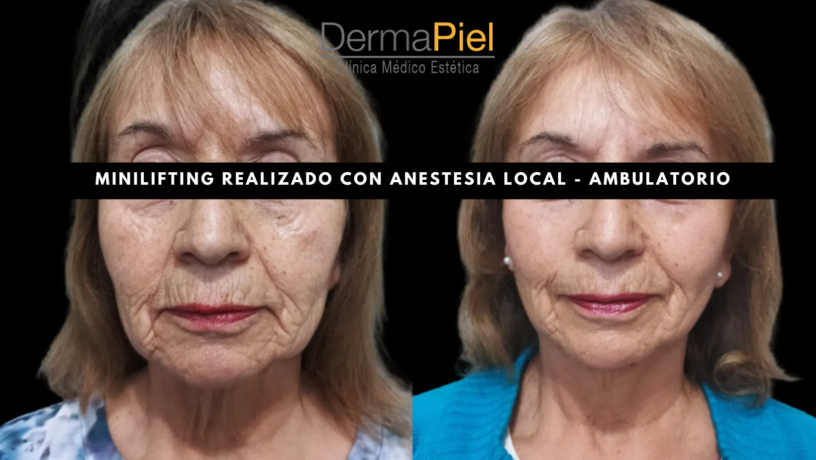 Minilifting Facial | Dermapiel