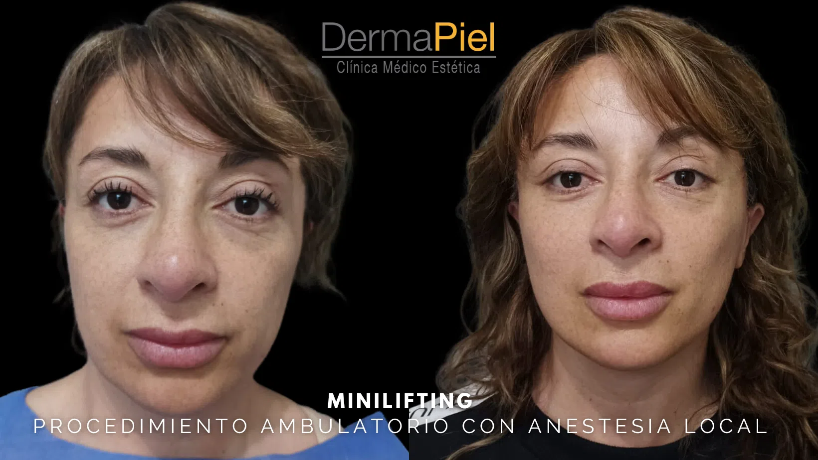 Minilifting Facial | Dermapiel
