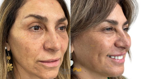 Rich PL ® el último avance en bioestimulación