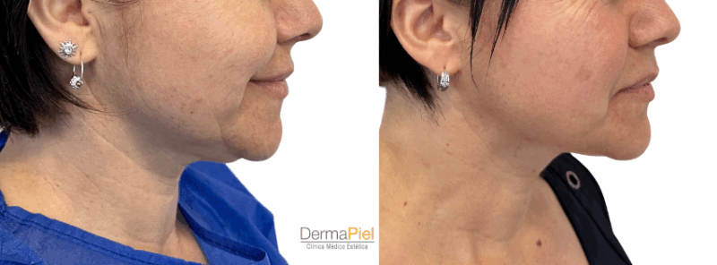 Endoláser para Reducción de Papada Tensado Facial - Endolifting