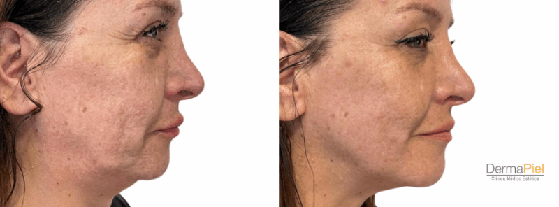 Endoláser para Reducción de Papada Tensado Facial - Endolifting